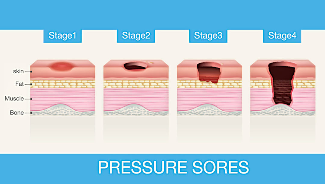 Tips for Differentiating Between Pressure Injuries and Moisture ...